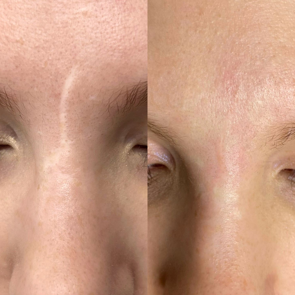 Как ухаживать после процедуры дермапигментации рубца или ареола